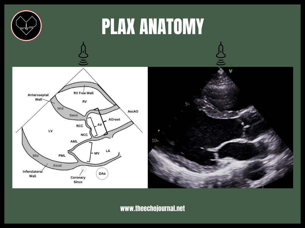 Parasternal Long Axis: What to Acquire and How to Measure
