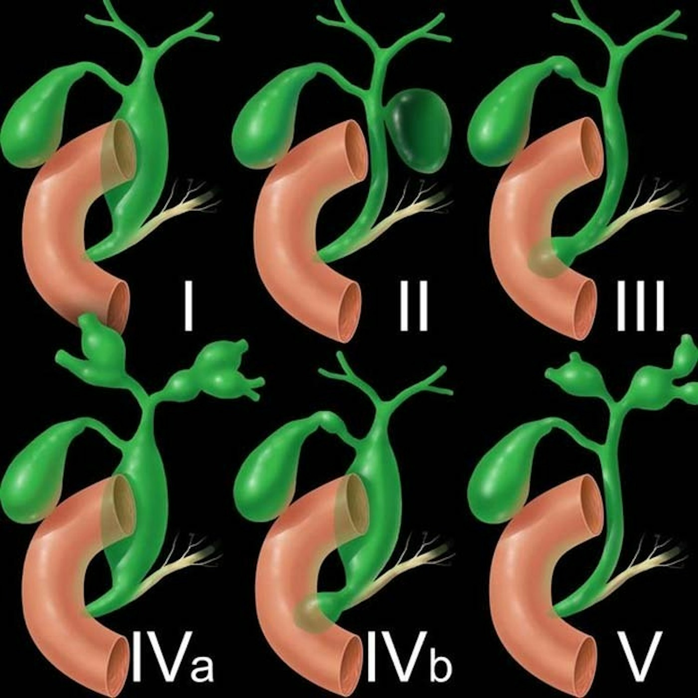 Todanic Classification of Choledocal Cysts - EndoCollab