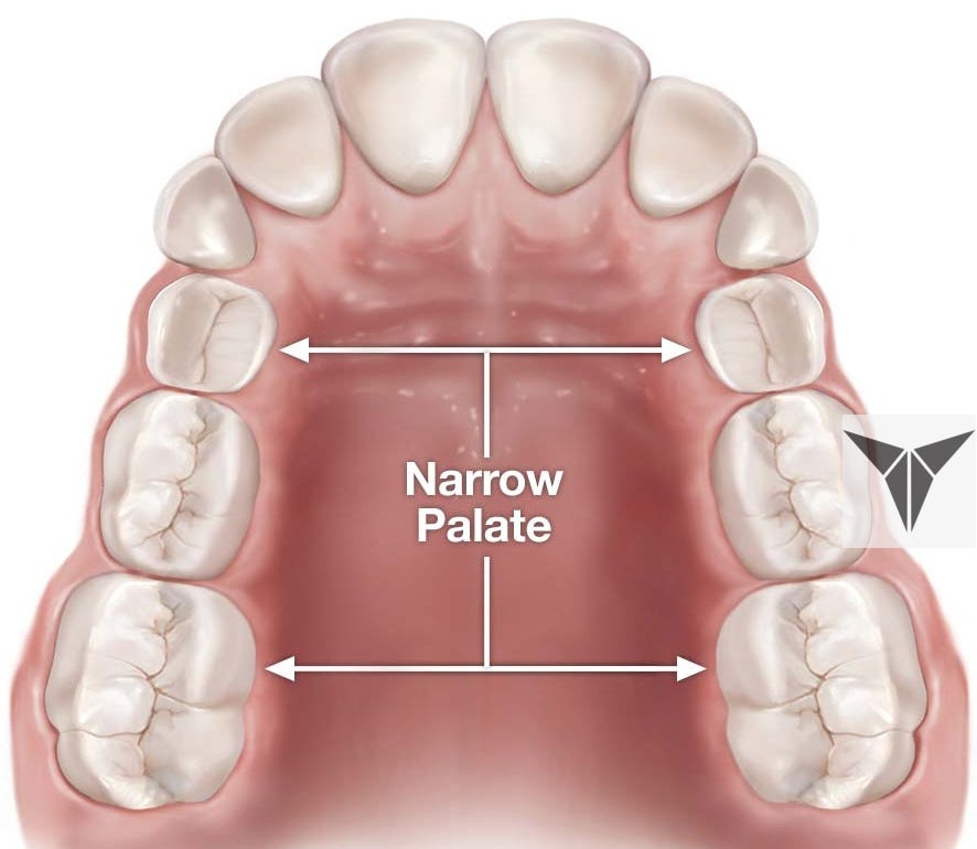 Strengthen your jaw, improve tongue posture, and fix facial imbalance ...