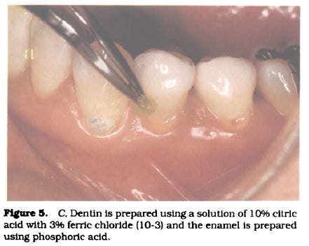 Hybrid Layer as a Dentin‑Bonding Mechanism - by Alex Besmer