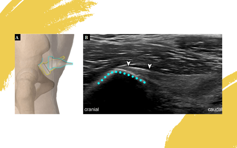 Iliopsoas, recto femoral y un nervio que no debes olvidar