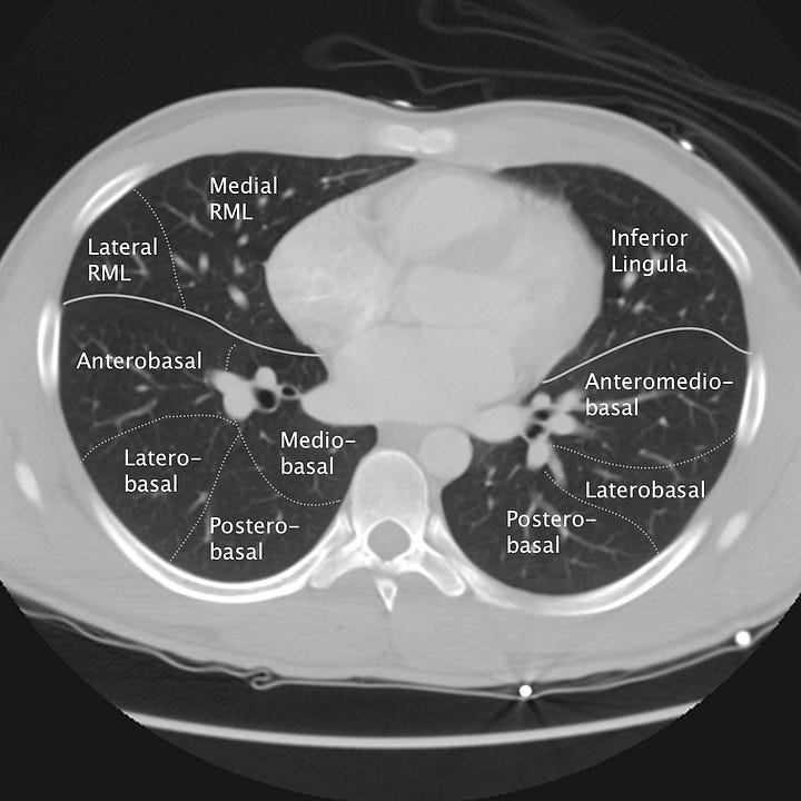 Chest anatomy - radiographs and CT - by Alexander Baxter