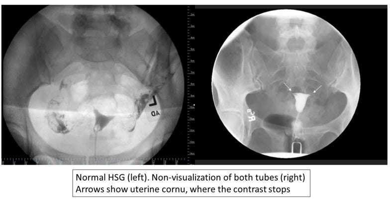 Non-visualization of Fallopian tube in HSG - by Dr. Huang