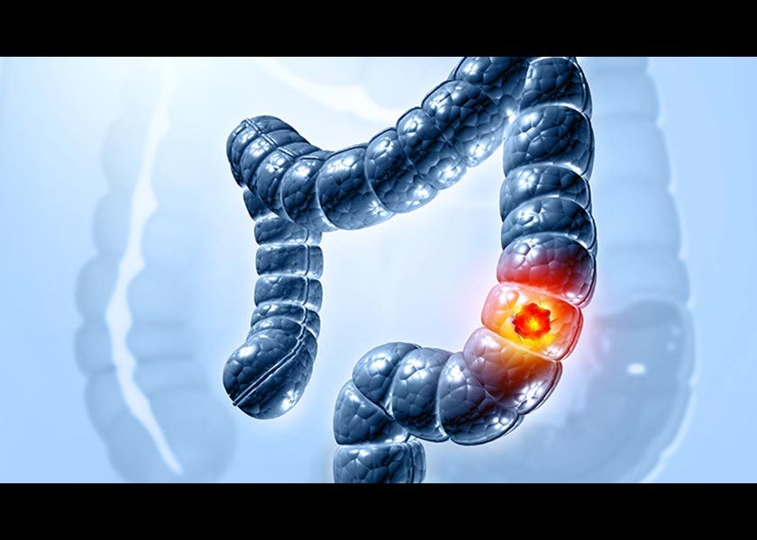 Ultraprocessed Foods Linked to Early Onset of Colorectal Cancer