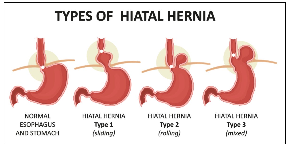You have a Hiatus hernia - now what?