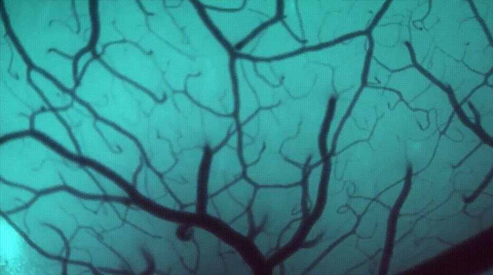 Musk’s Neuralink Breakthrough: 10,000 Queue for Brain Implant