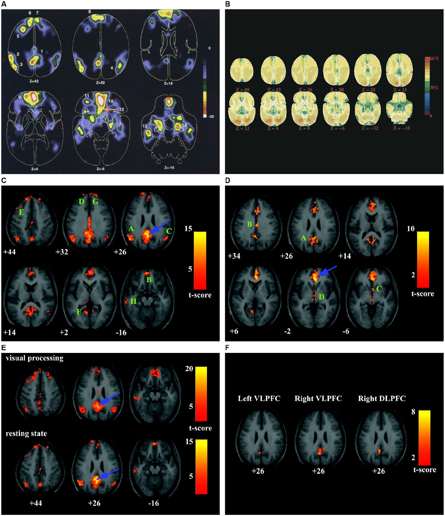 Vinod Menon has a nice review of the default mode network (DMN ...