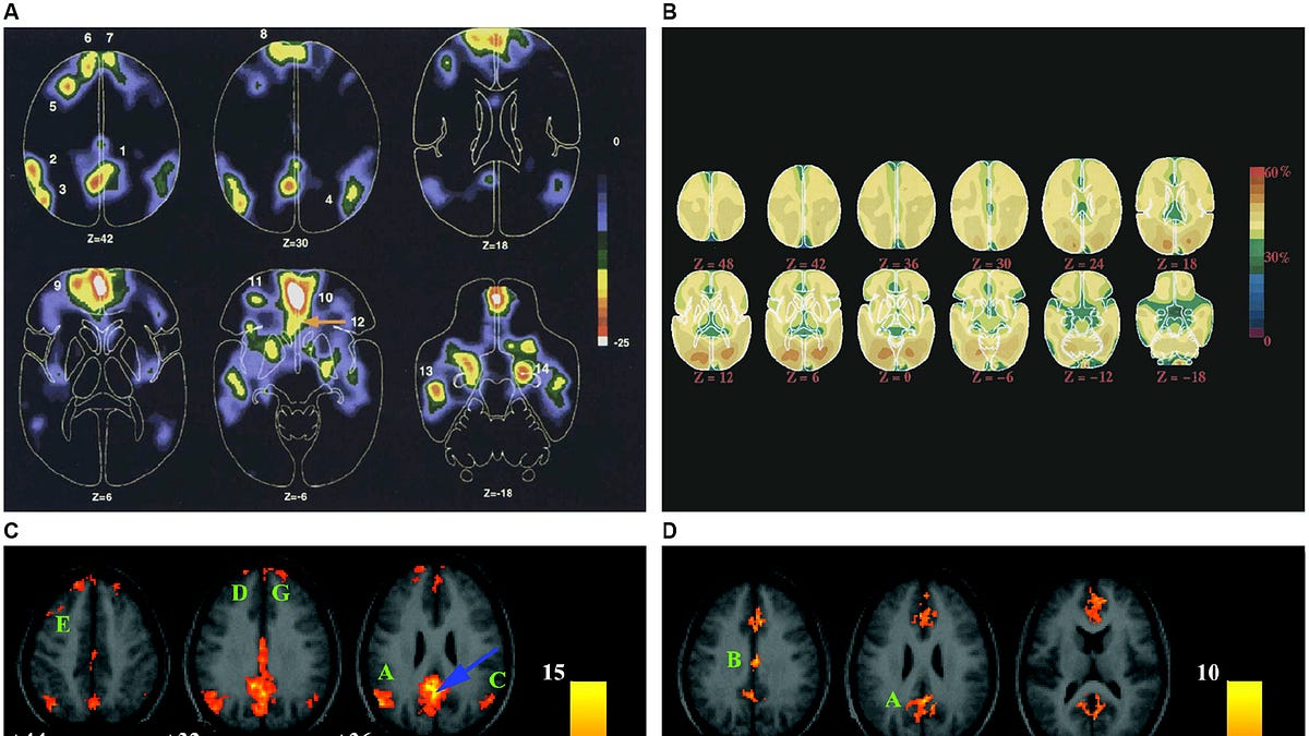 Vinod Menon has a nice review of the default mode network (DMN ...