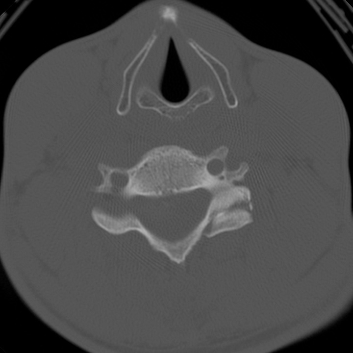 Cervical Spine Hyperflexion Injuries - by Alexander Baxter
