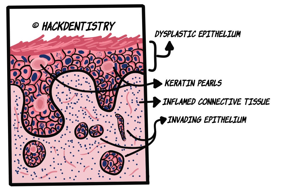 Oral squamous cell carcinoma - Clinical features and Histopathology