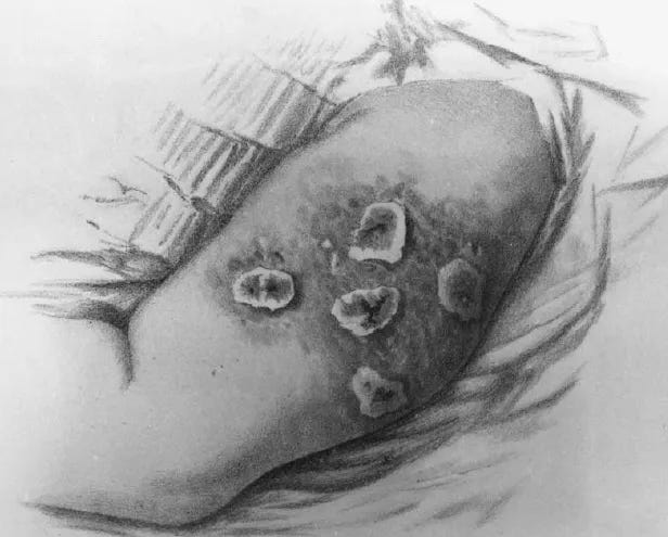 What Can The Smallpox Vaccine Disaster Teach Us About Spike Protein ...