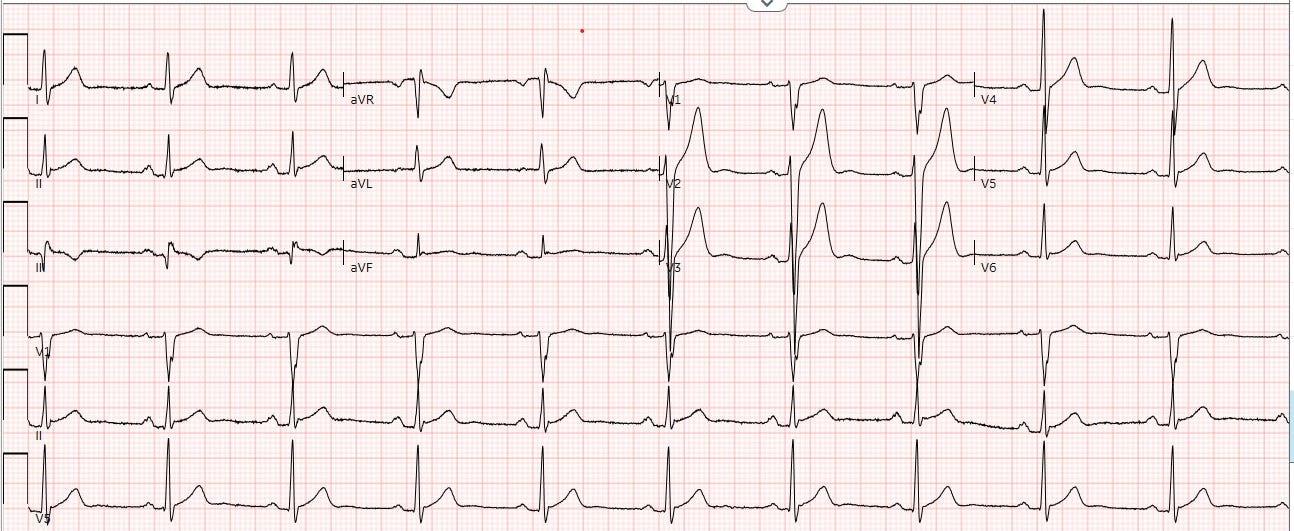 #4 - Knowing What to Expect from an Anterior versus Inferior Wall ...