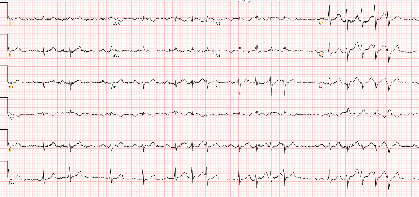 Know the 3 Causes of Irregularly Irregular Rhythms