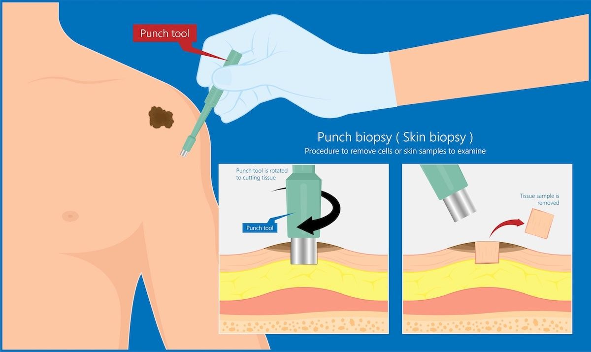 Why Is My Skin Losing Color? Understanding Hypopigmentation