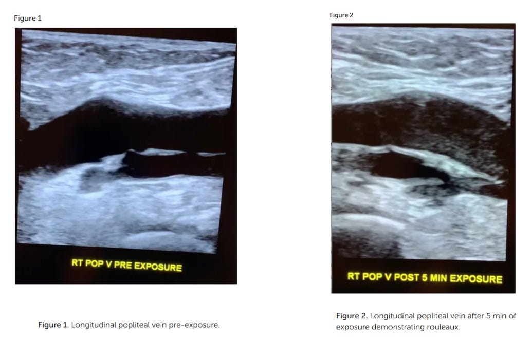Smart Phone Exposure Shows Rouleaux Formation Via Ultrasound In Large ...