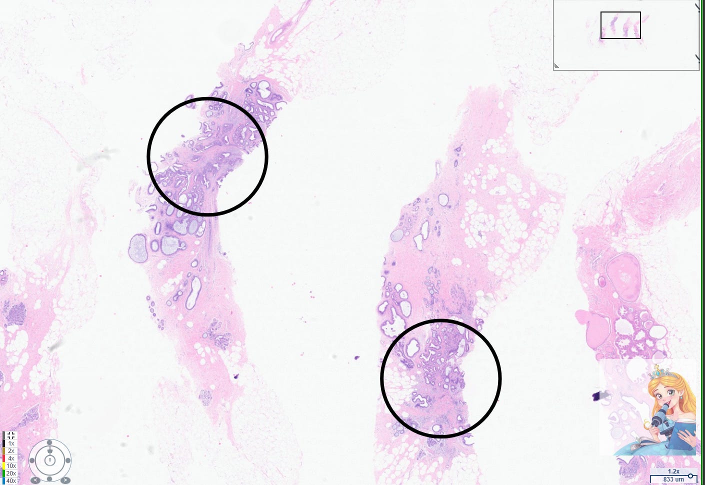 Radial Scar/Complex Sclerosing Lesion - by Chelsea Mehr, MD