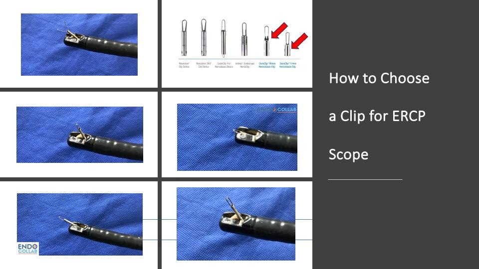 Endoscopic Management of Post-Sphincterotomy Bleeding: Eight Hemostatic ...