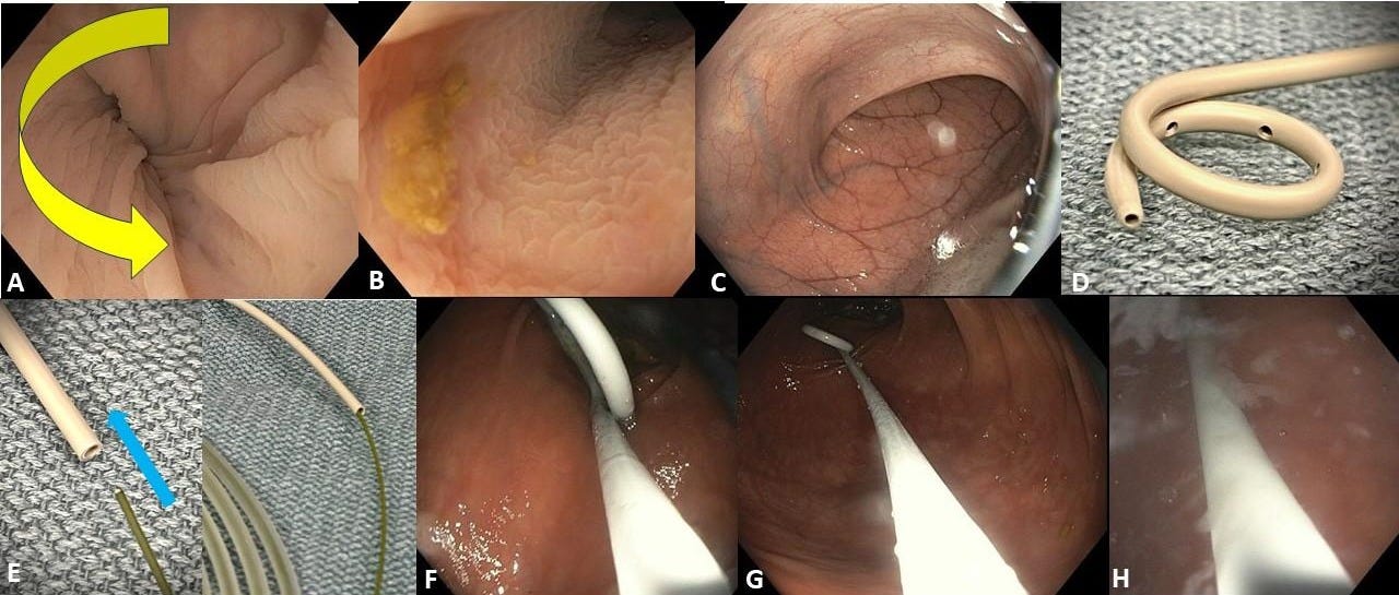 Device Review: How to Place a Rectal Decompression Tube Through-The-Scope