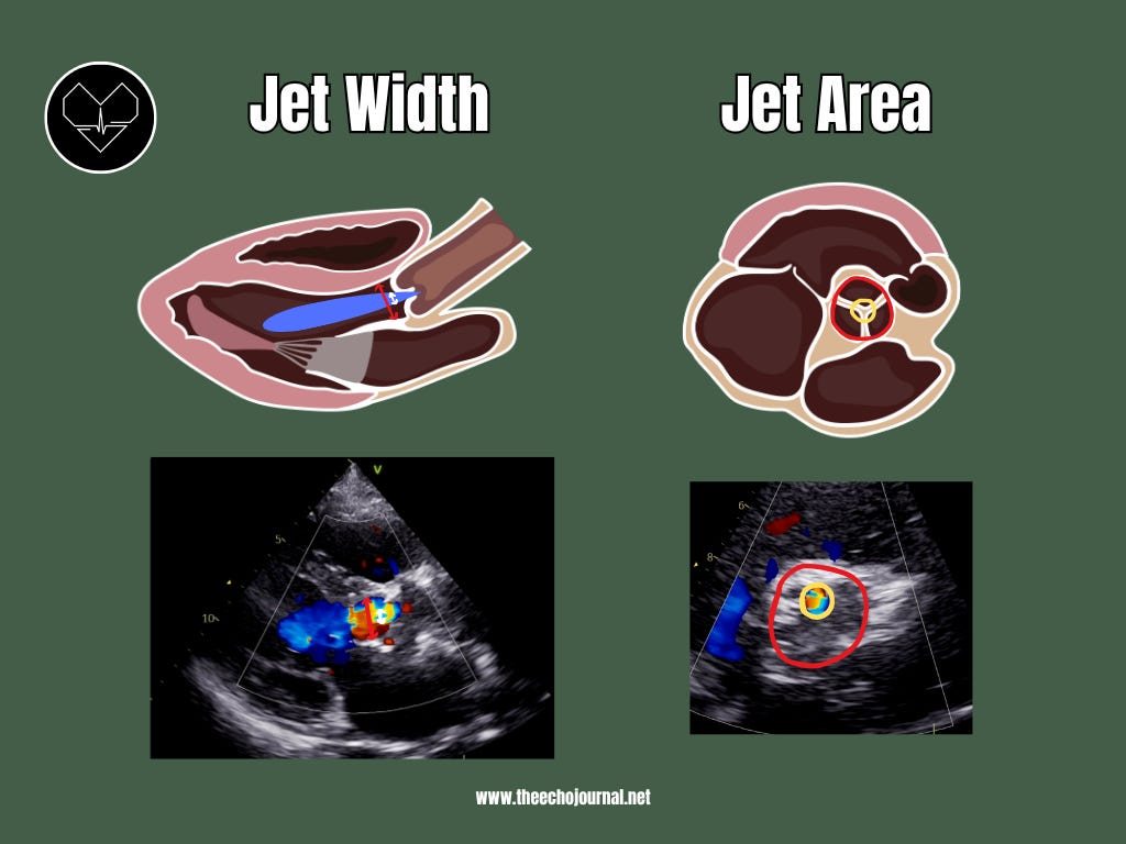 Aortic Regurgitation & Color Doppler - Would You Catch These Findings?