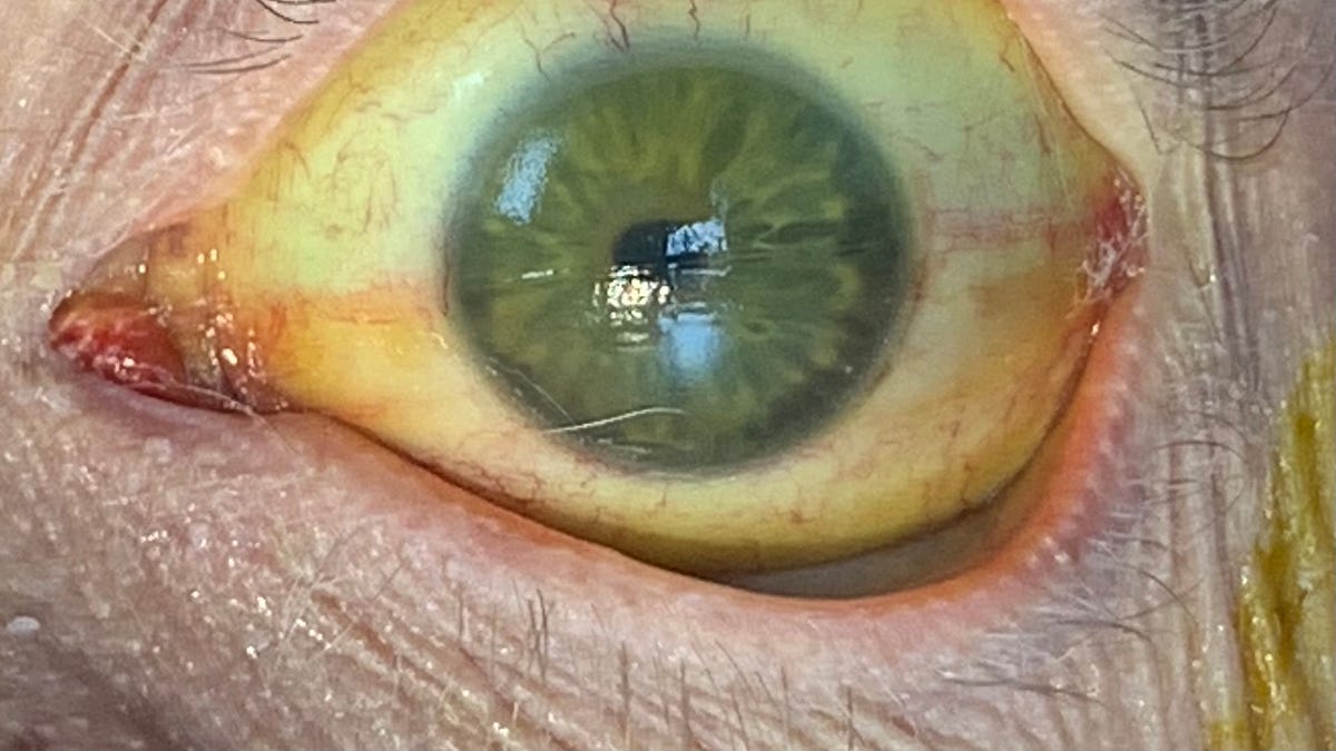 scleral icterus present