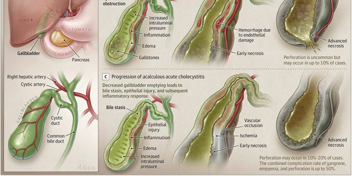 cholecystitis cks