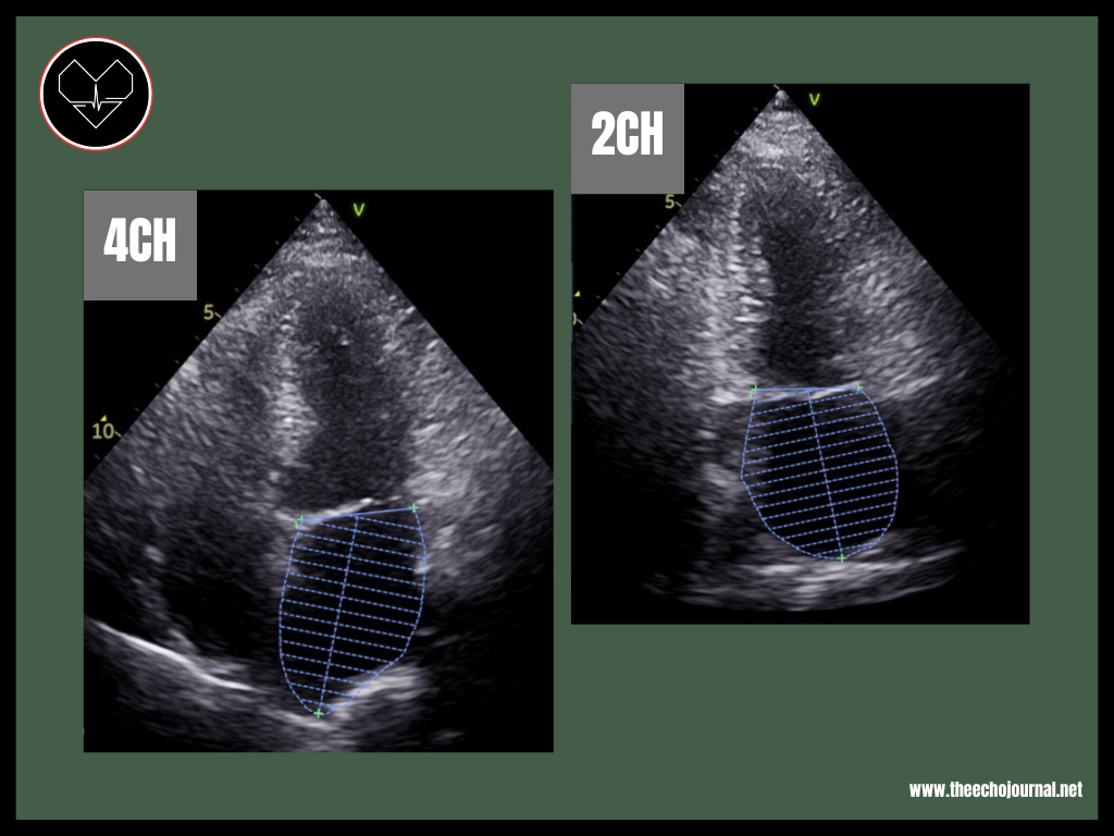 How To: Measure Left Atrial Volumes - The Echo Journal