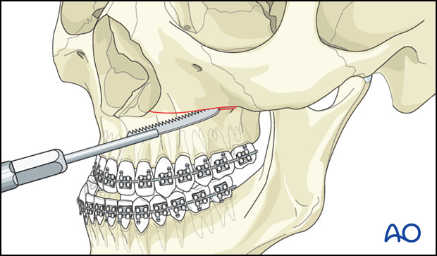 5.4 MARPE Surgical Assists - From Least to Most Invasive