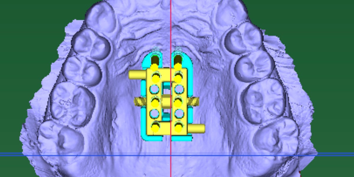 5.1 Intro to MARPE - by Ronald Ead - JawHacks