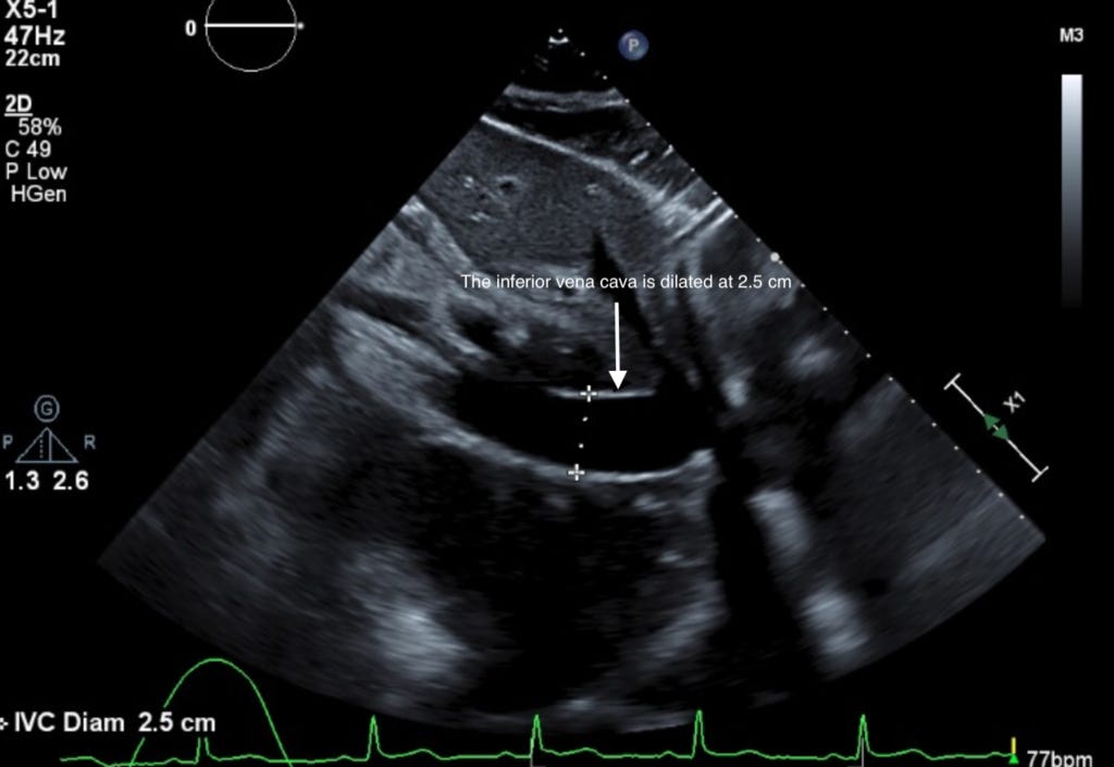Cardiac Tamponade (Part 1) - by Arman Hussain