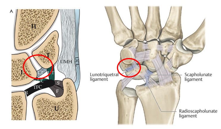 Clinician's Corner | Ulnar Wrist Pain - Most of the Time It Isn’t a ...