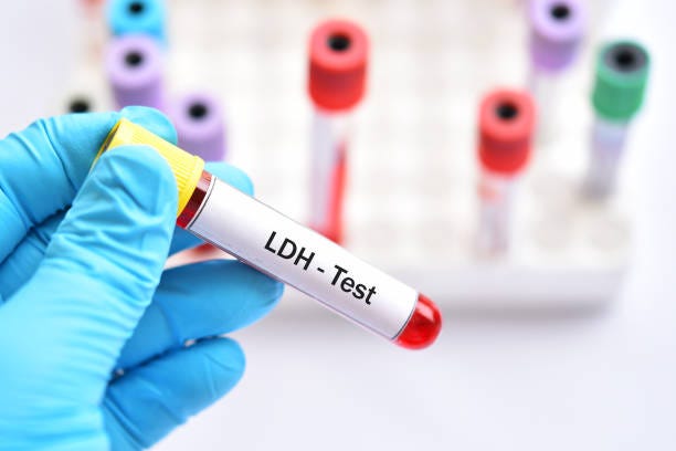 Lactate dehydrogenase (LDH) test: Uses and results