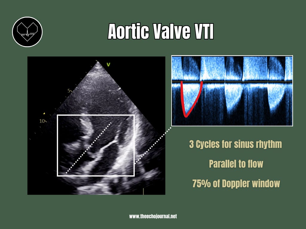 Aortic Stenosis: How to Calculate an AVA - by Aram K.