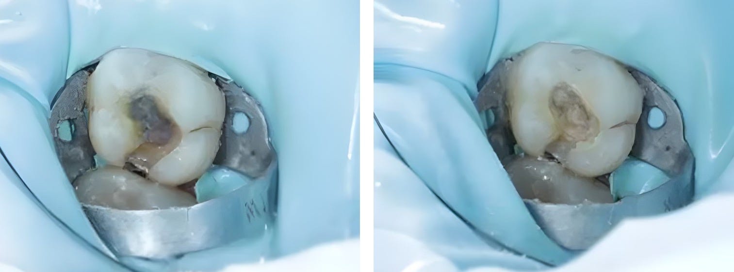 MasterPeace and Safe Dental Amalgam Removal