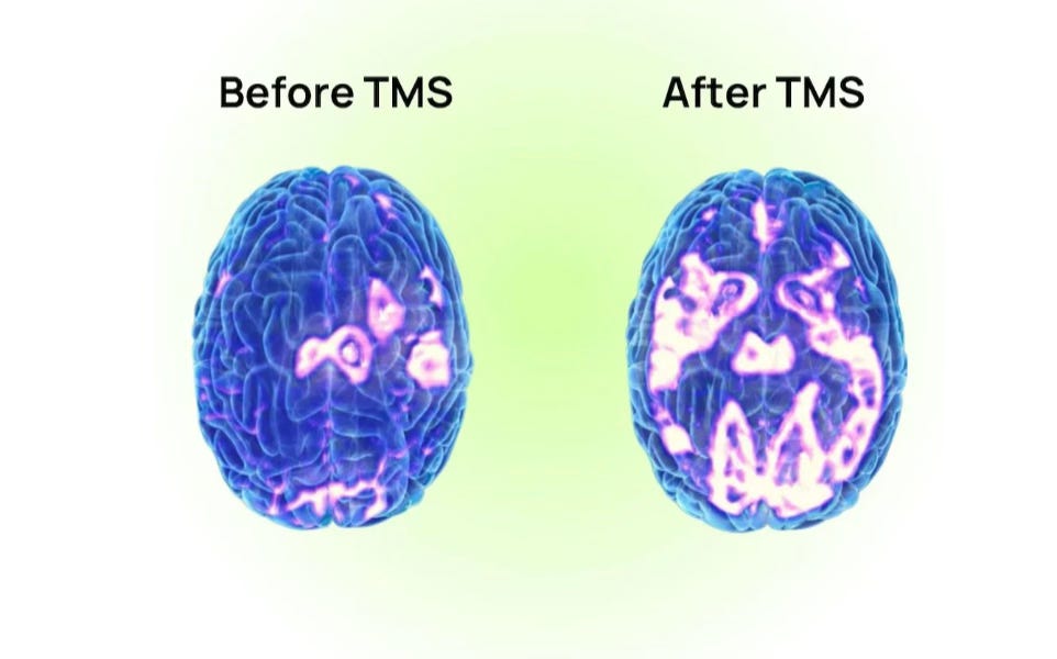 What Does TMS Actually Do?