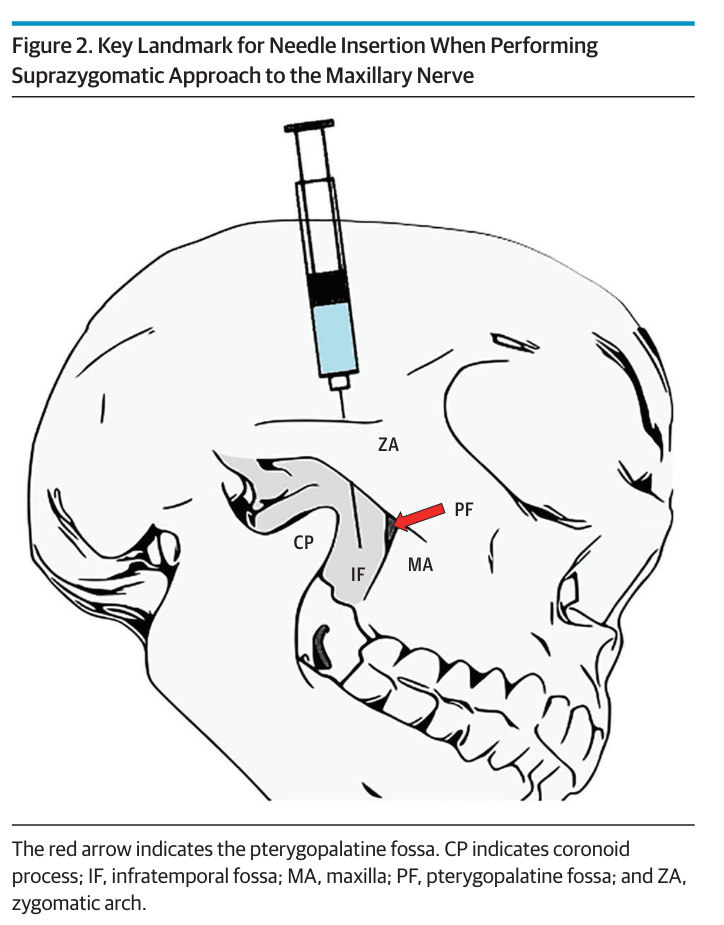 Maxillary Nerve Block Technique