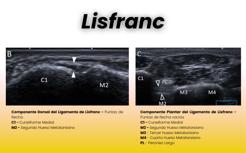 Lisfranc y Chopart: más que un bonito nombre
