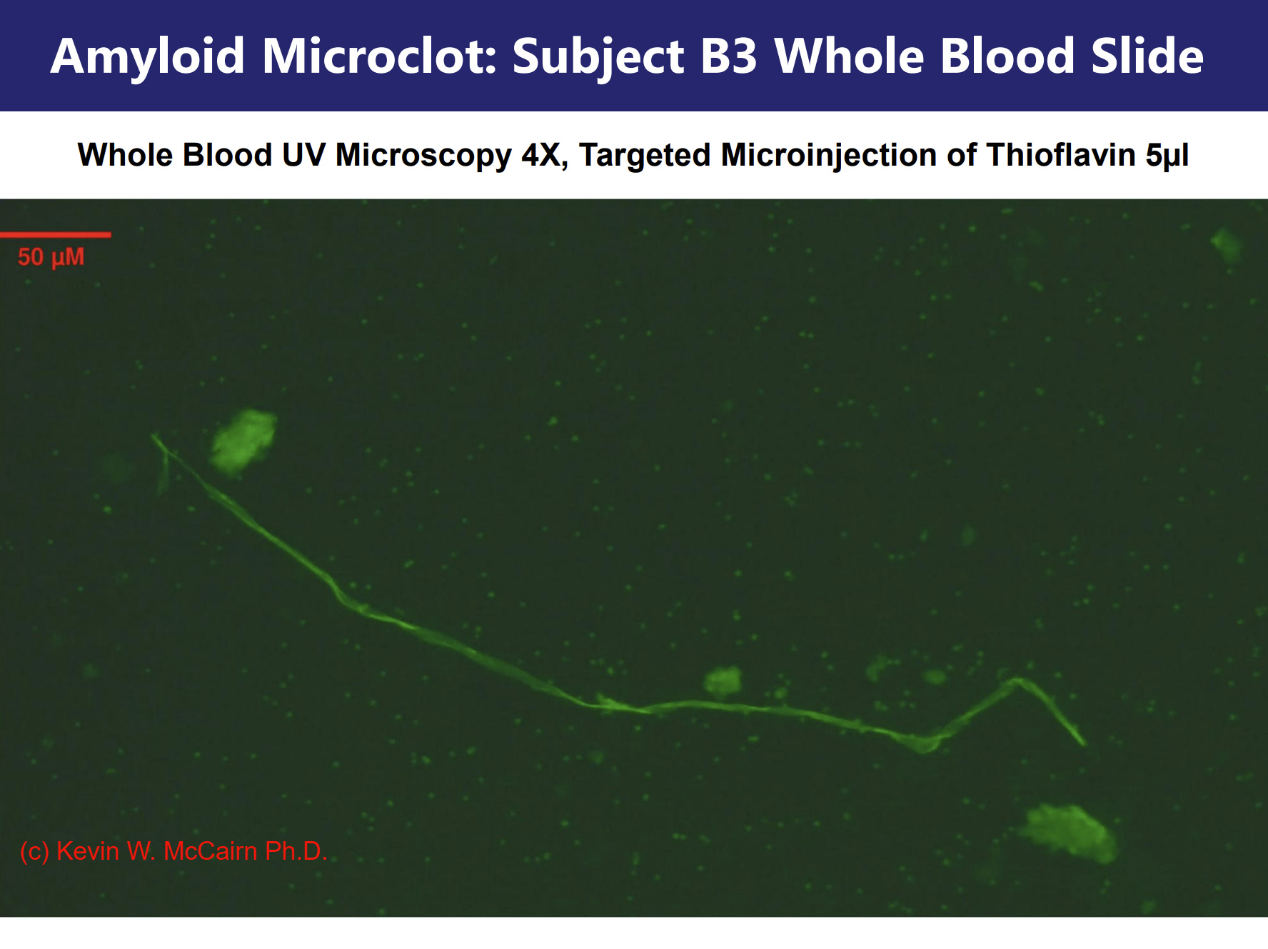 BREAKING: Prion-Like Amyloid Fibrils Found in 3-Year-Old Born Lifeless ...