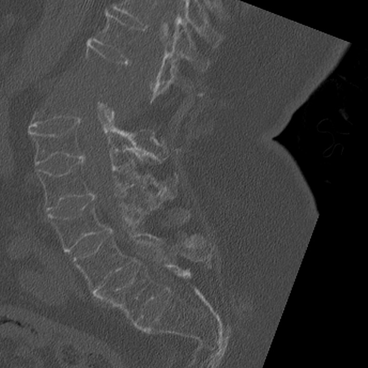 Spinal distraction injuries and dislocation