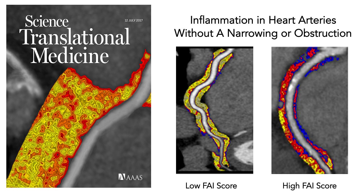 The Big Shift in Cardiology to Atheroma and Inflammation