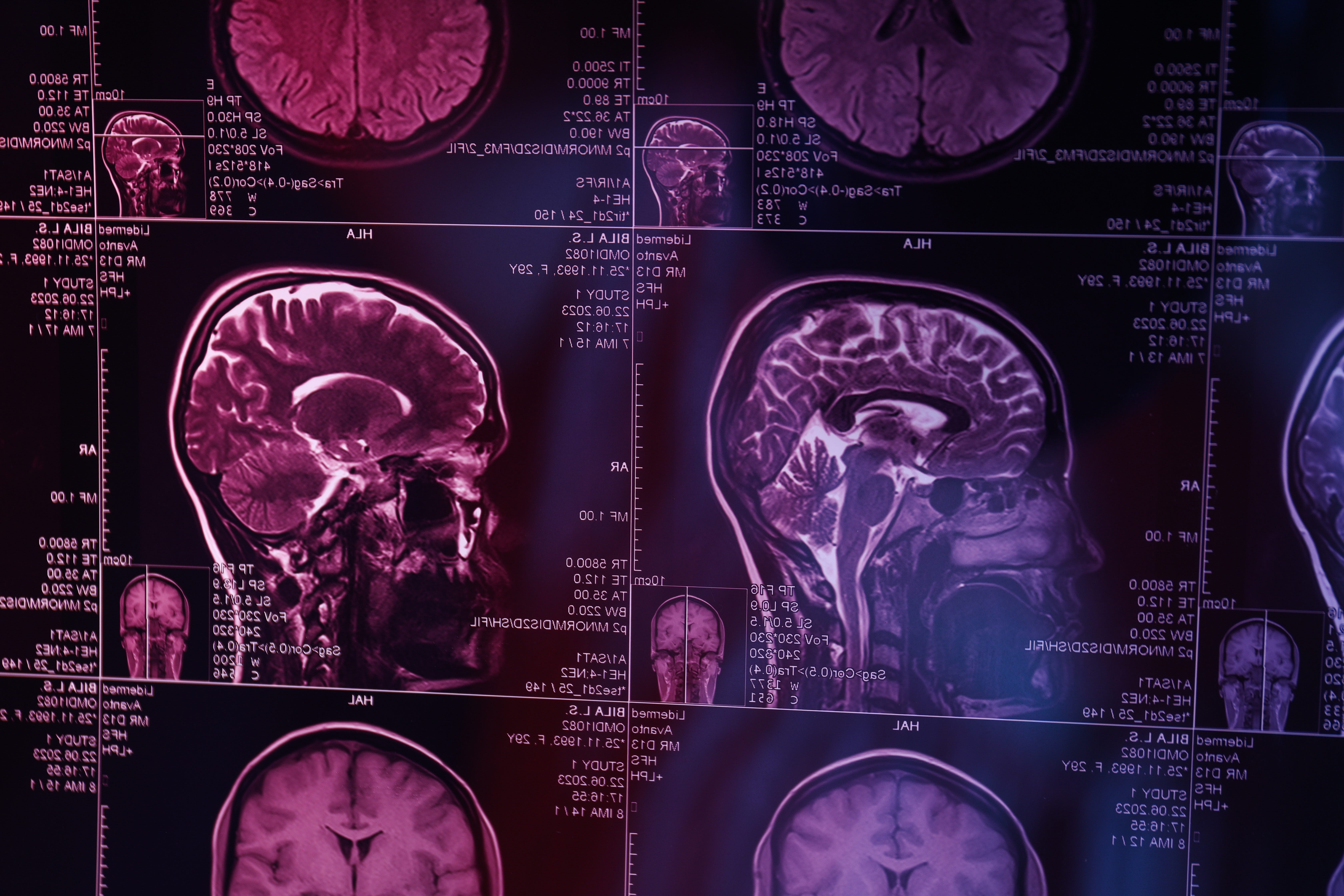 5 things you didn’t know about multiple sclerosis (MS)