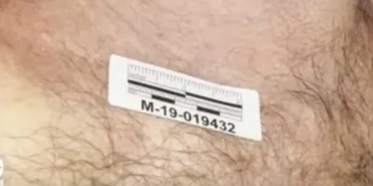 Epstein: A Forensic Assessment of Autopsy Photo of Epstein's Ligature Marks