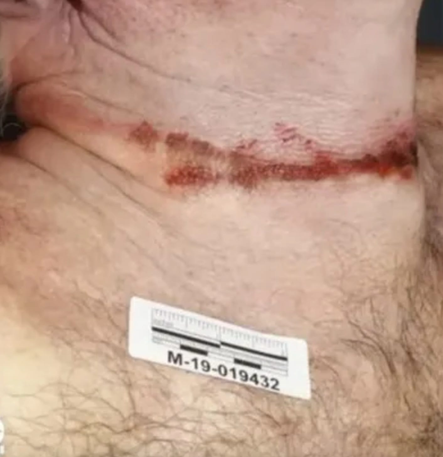 Epstein: A Forensic Assessment of Autopsy Photo of Epstein's Ligature Marks