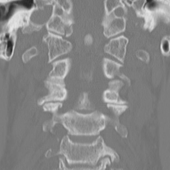 Occipital condyle fracture - by Alexander Baxter - RadNotes