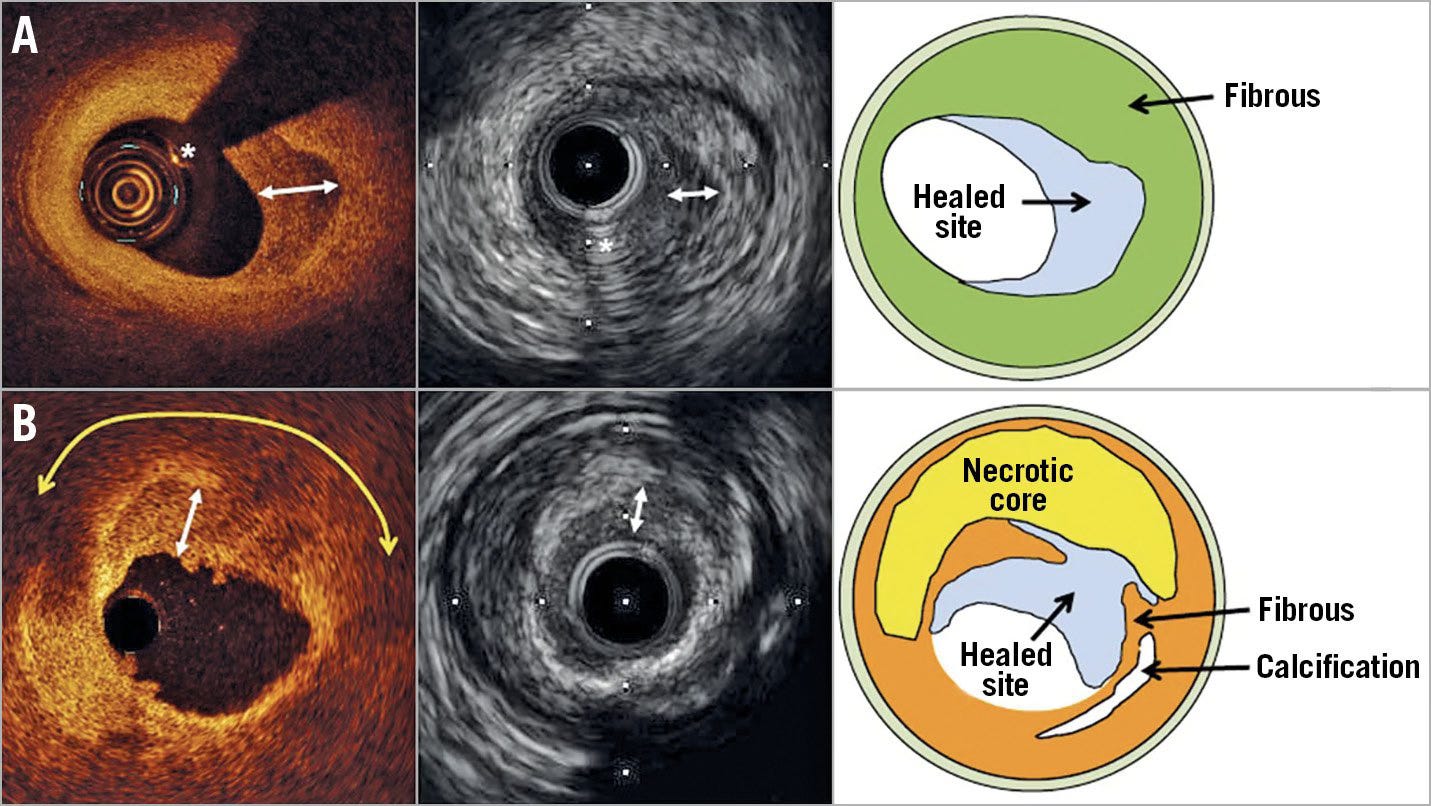 how do atheromas form