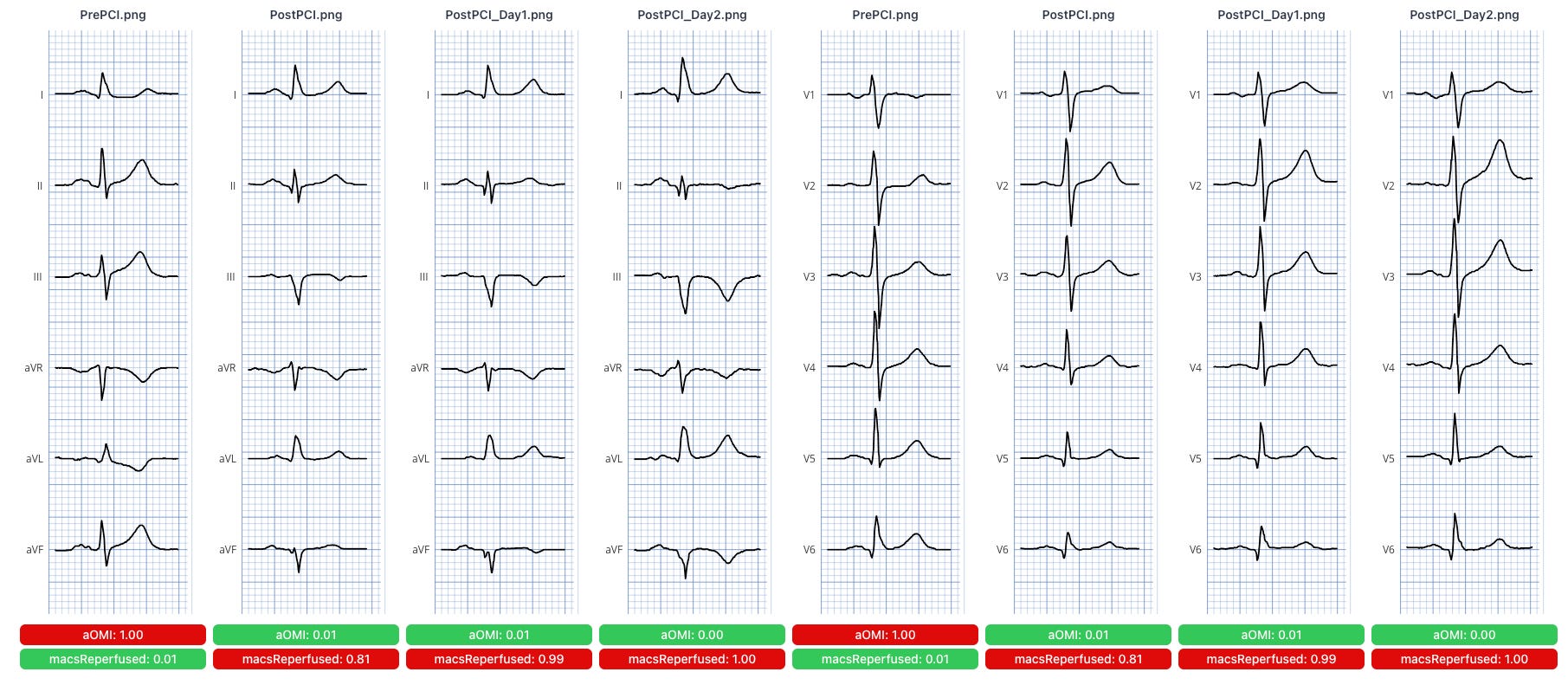 Inferior OMI ECG: Hyperacute T-Waves, Delayed Recognition, and ...