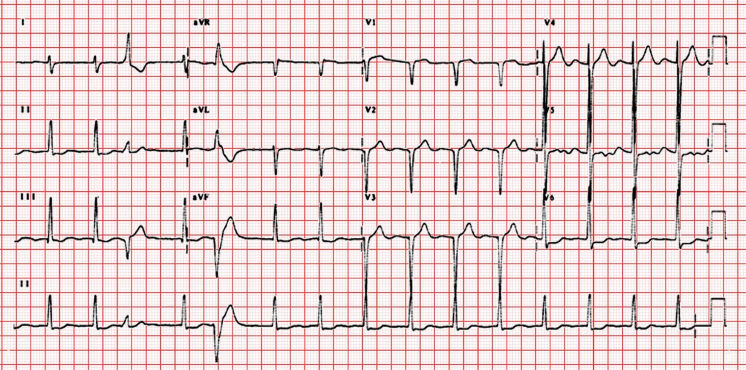 Premature complexes: atrial vs junctional vs ventricular