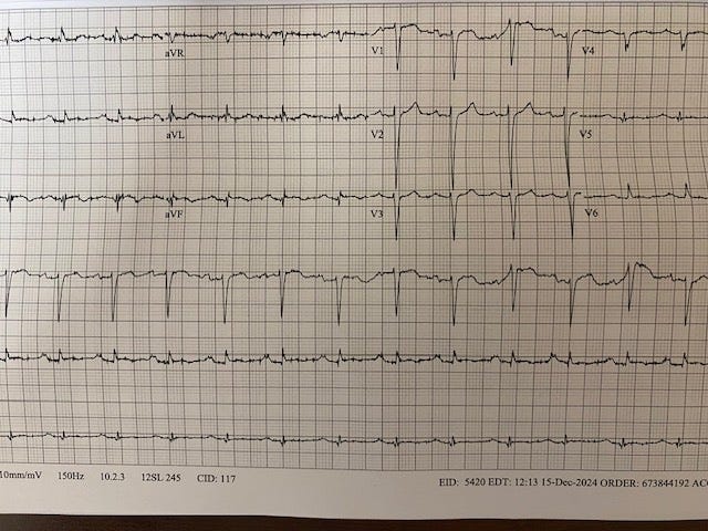 Pulmonary Edema With or Without Peripheral Edema