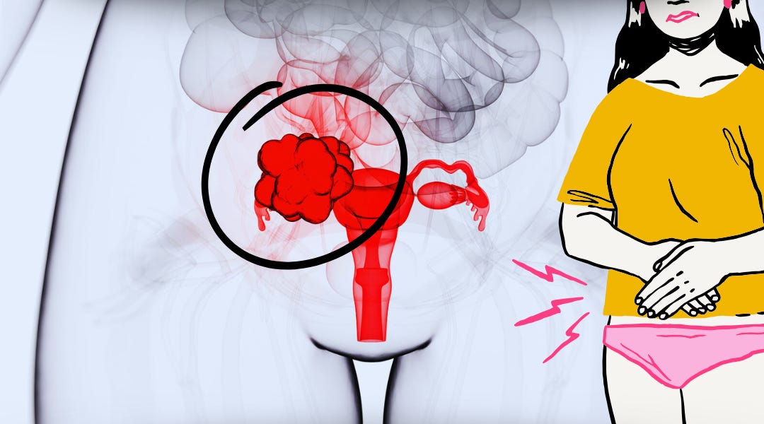 Cisto unilocular: o que é, sintomas, causas e como tratar