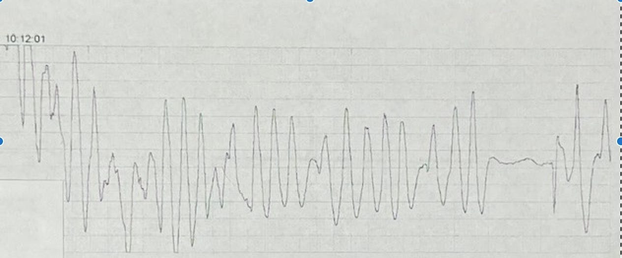 Atrial Fibrillation with a Rapid Ventricular Response Can Mimic VT