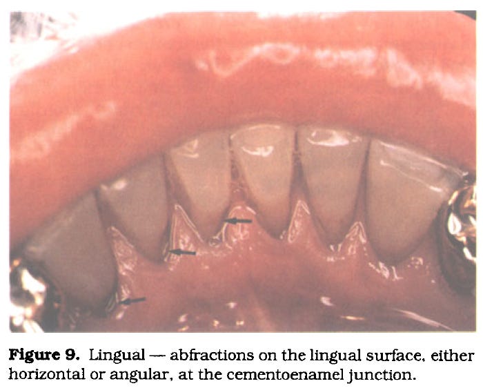 Abfractions: A New Classification of Hard Tissue Lesions of Teeth
